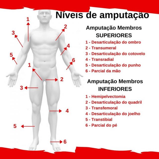 Tipos de Amputações: Causas e Níveis de Amputação - Bionicenter