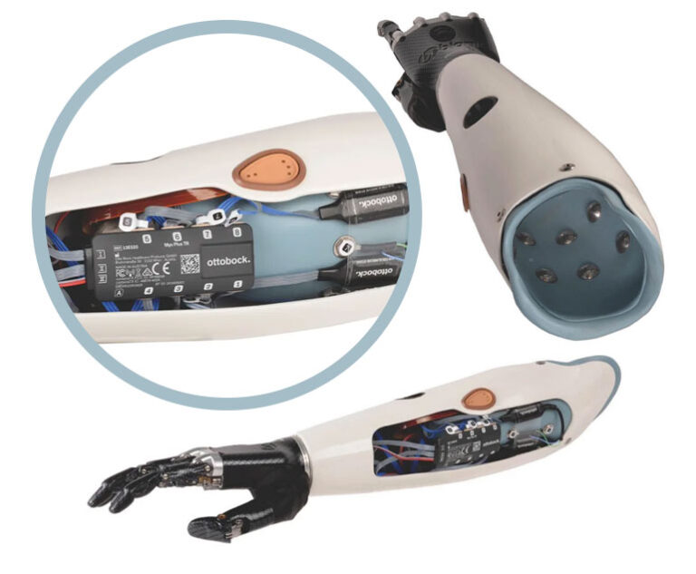 MyoPlus: A Inovação em Prótese de Mão Biônica - Excelência em Próteses ...