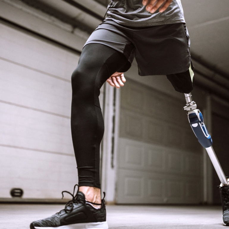 Amputação Transfemoral: O que é, Tipos de Próteses