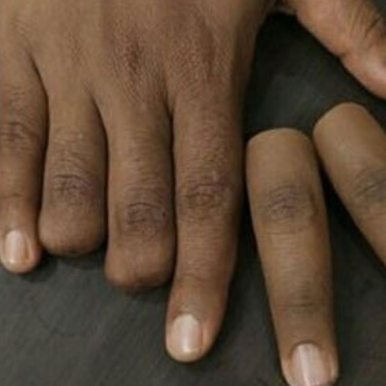 Amputação de pé: Conheça os Tipos, Causas e Próteses